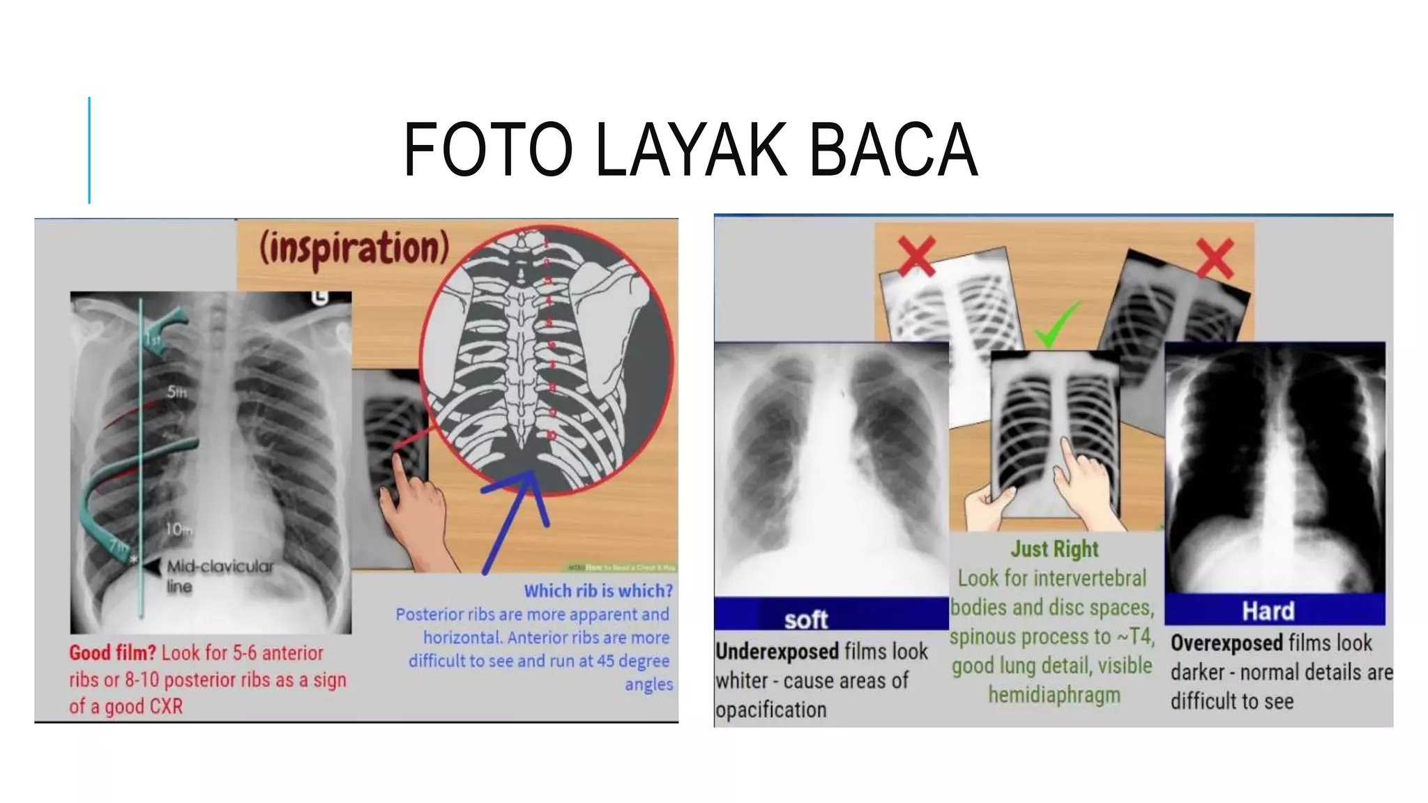 Teknik Radiografi Thoraks.pptx