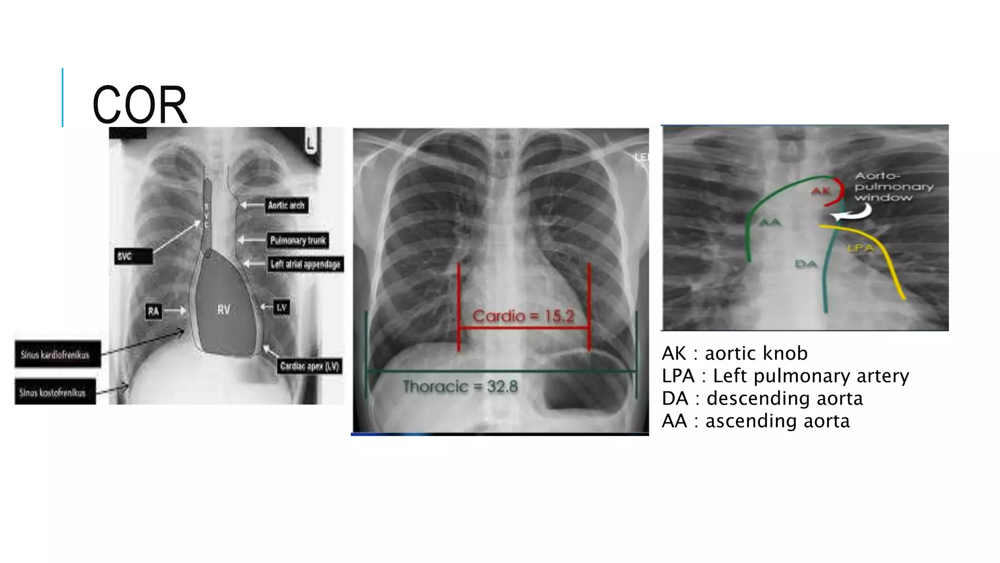 Teknik Radiografi Thoraks.pptx