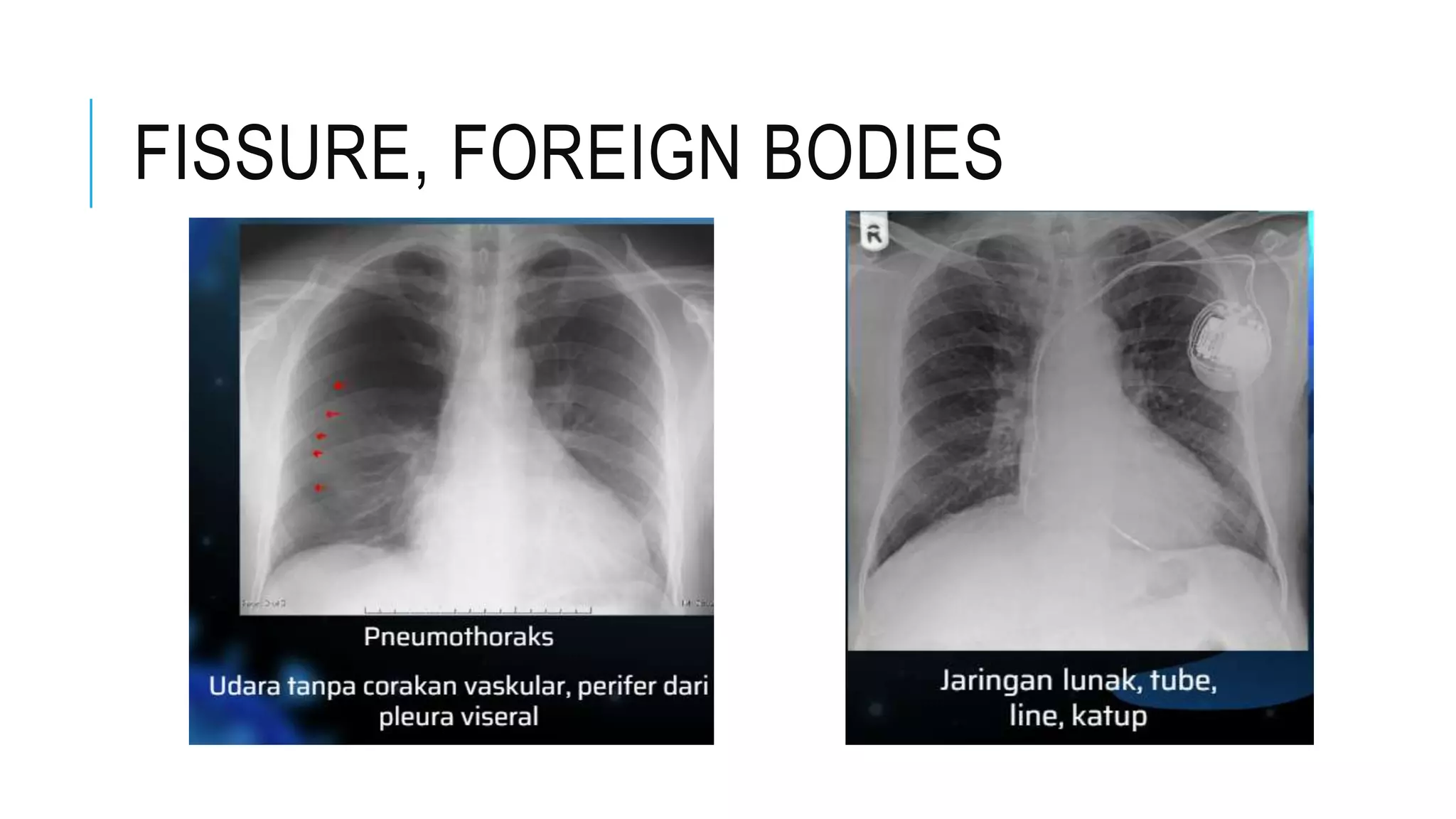 Teknik Radiografi Thoraks.pptx