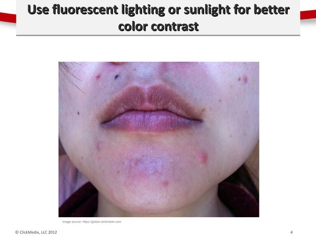 How to take pictures for teledermatology: remote diagnosis of ...