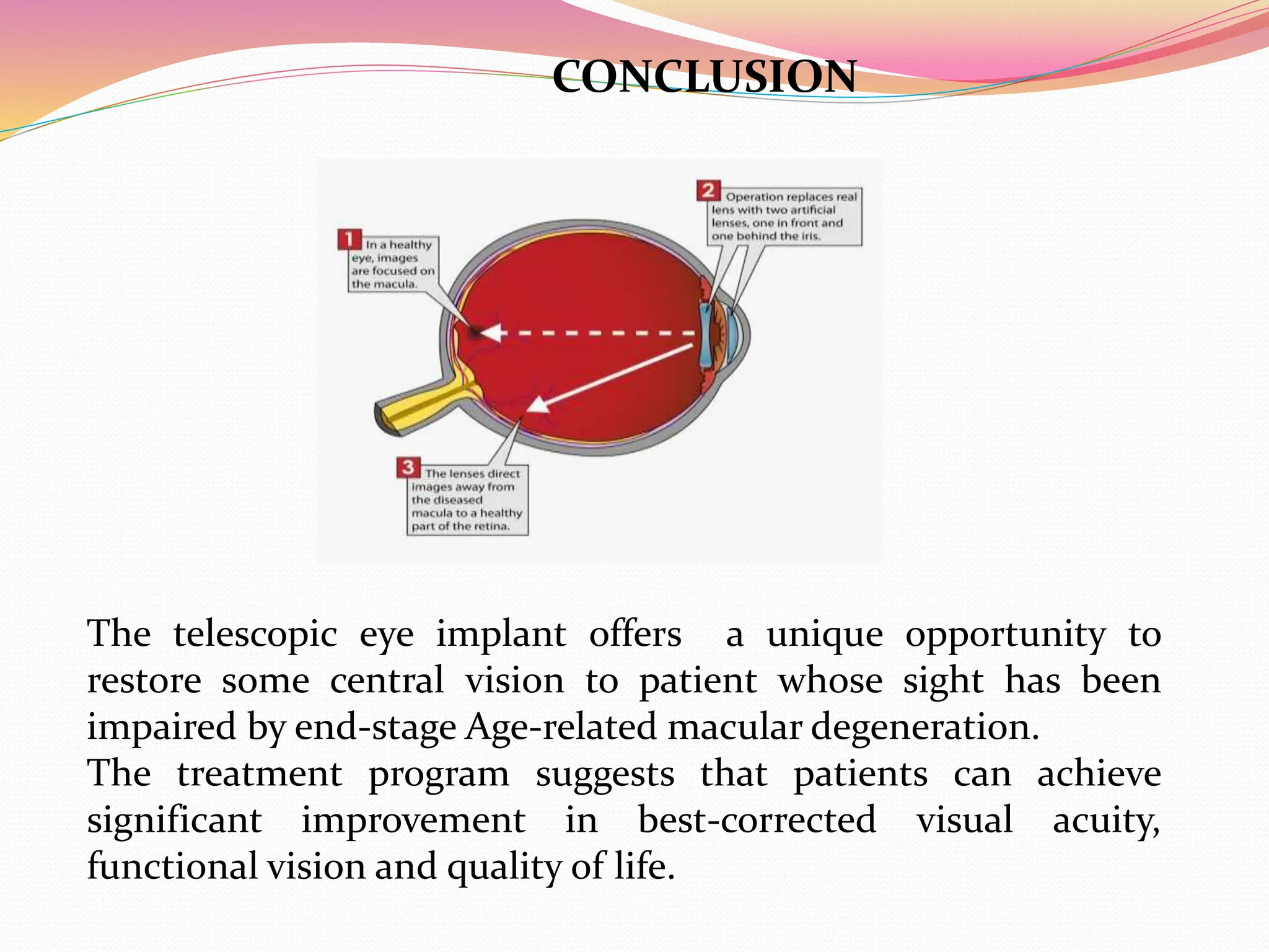Telescopic eye implant in optometry profession | PPTX