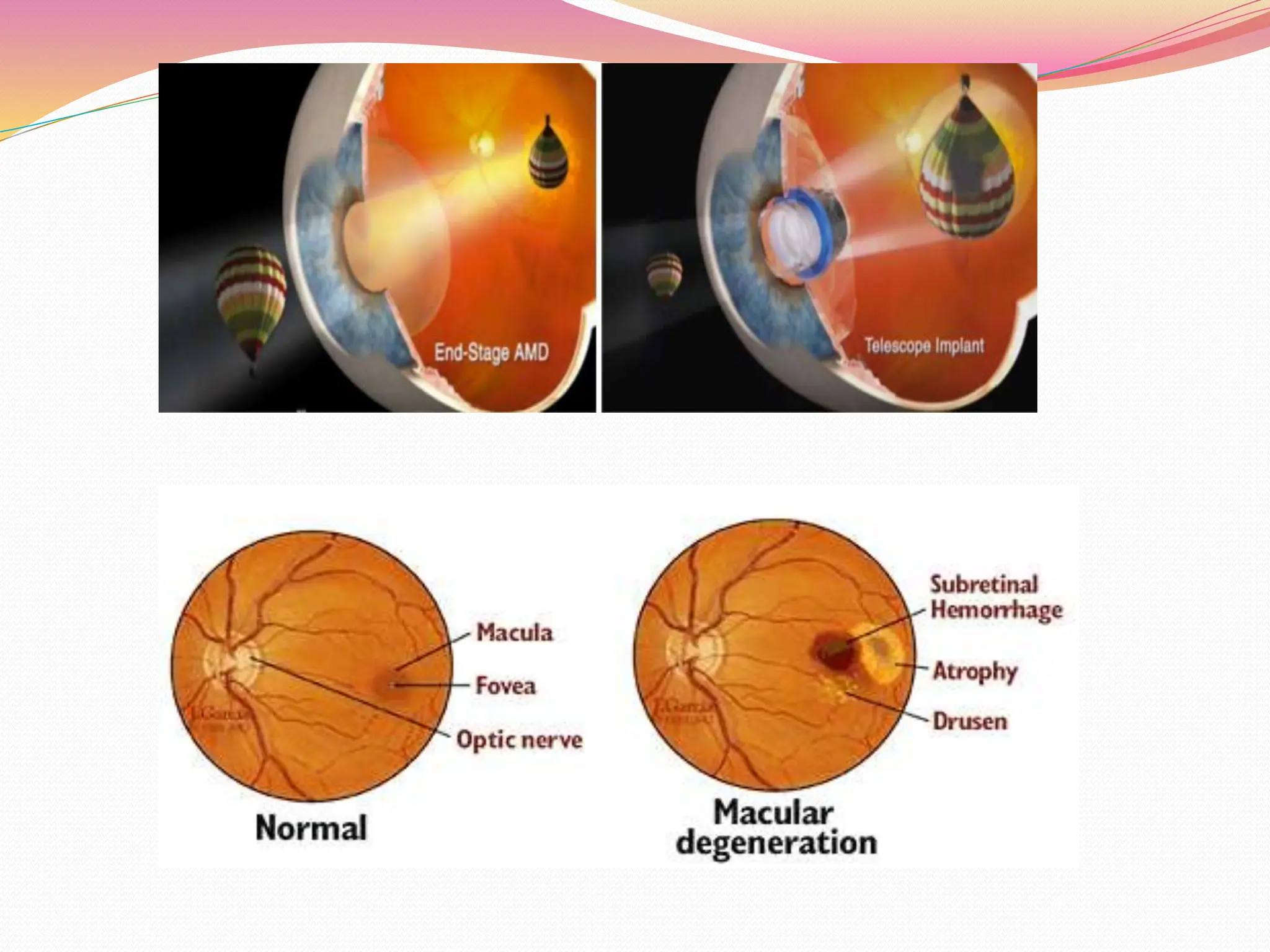 Telescopic eye implant in optometry profession | PPTX