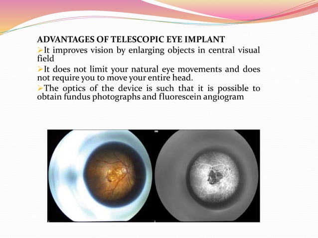 Telescopic eye implant in optometry profession | PPT