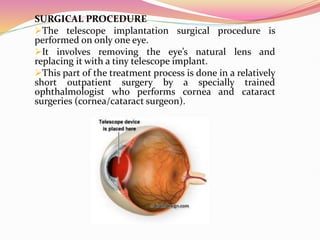 Telescopic eye implant in optometry profession | PPT