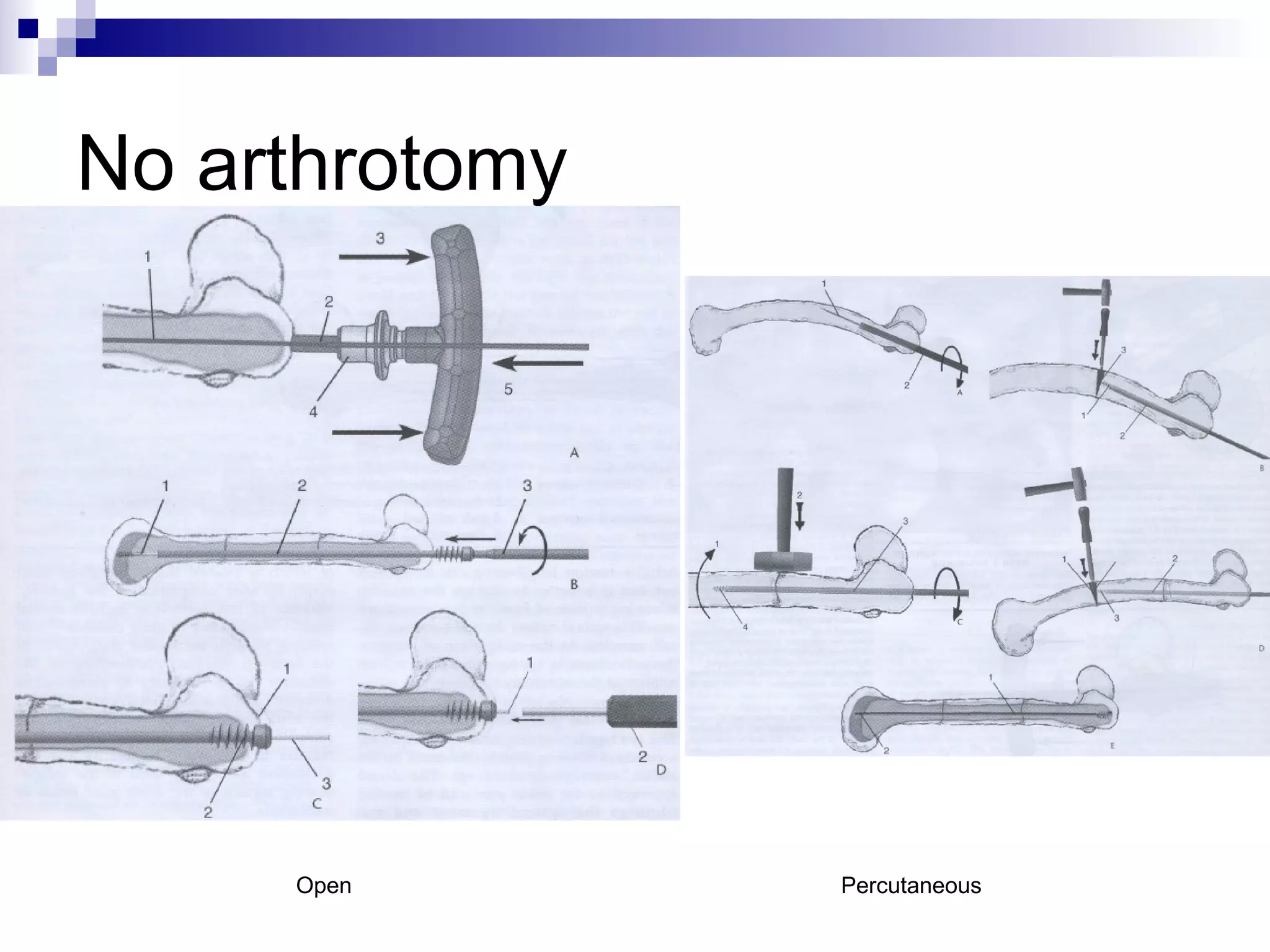 Telescopic nails in Osteogenesis Imperfecta | PPT