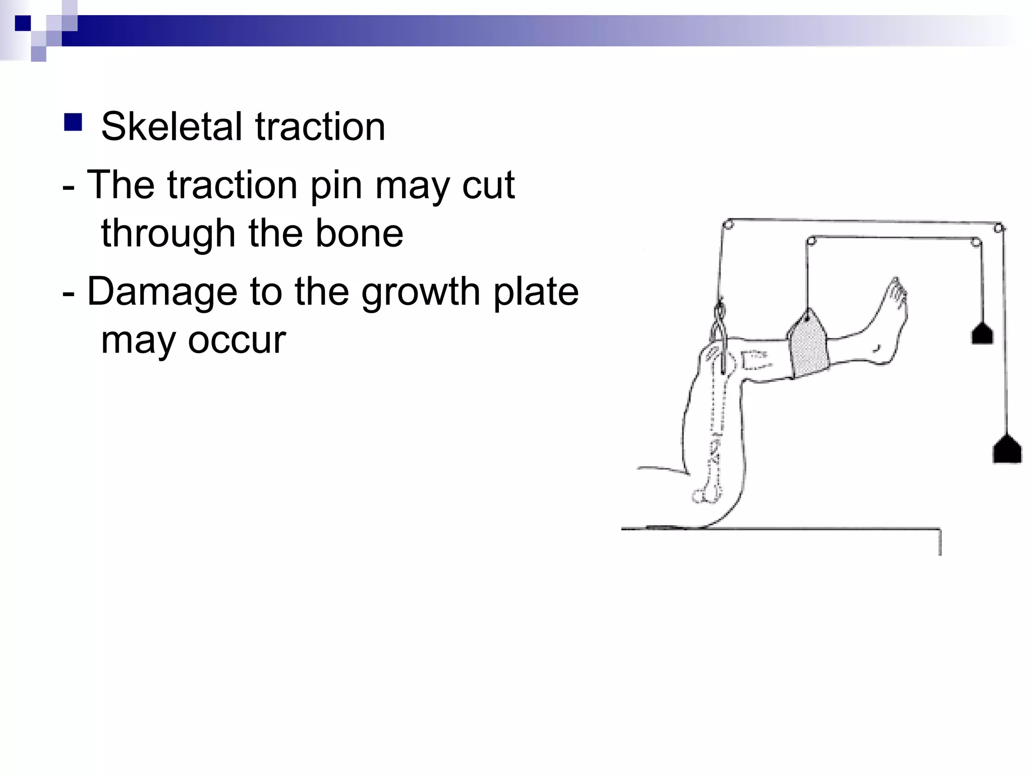 Telescopic nails in Osteogenesis Imperfecta | PPT