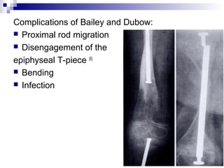 Telescopic nails in Osteogenesis Imperfecta | PPT