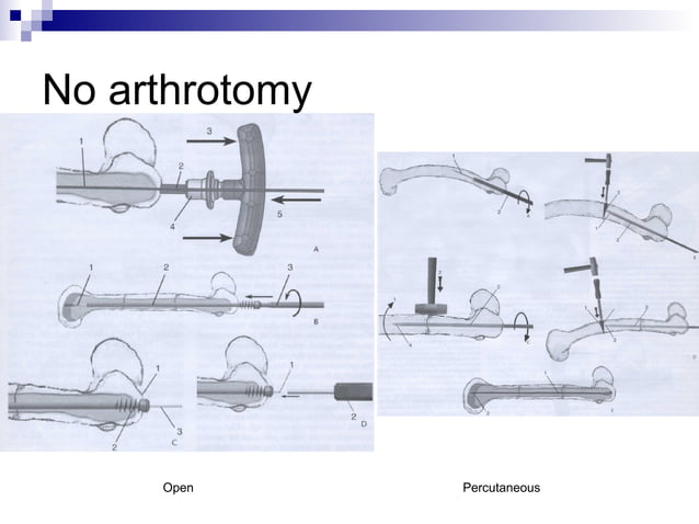 Telescopic nails in Osteogenesis Imperfecta | PPT | Death, Injury, or ...