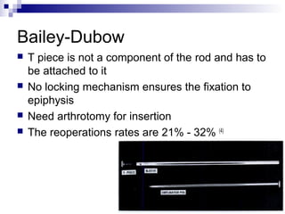 Telescopic nails in Osteogenesis Imperfecta | PPT