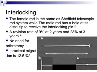 Telescopic nails in Osteogenesis Imperfecta | PPT