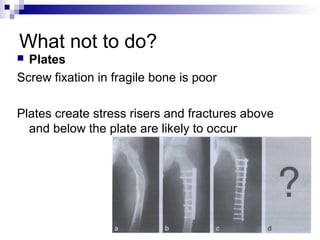 Telescopic nails in Osteogenesis Imperfecta | PPT