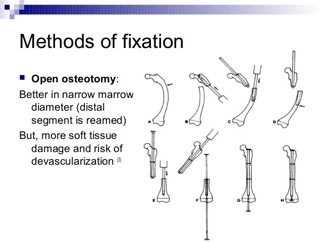 Telescopic nails in Osteogenesis Imperfecta