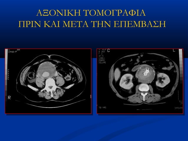 Ανεύρυσματα κοιλιακής αορτής – Ενδαγγειακή Αντιμετώπιση | PPT