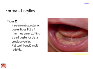 Tel lingual. diagnòstic i tractament 2014 | PDF