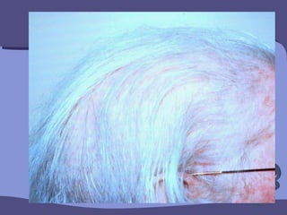 Telogen Effluvium | PPT