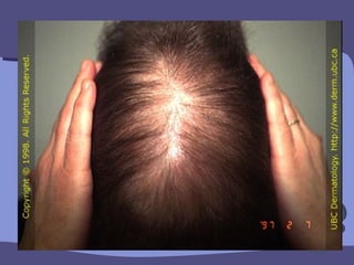 Telogen Effluvium | PPT