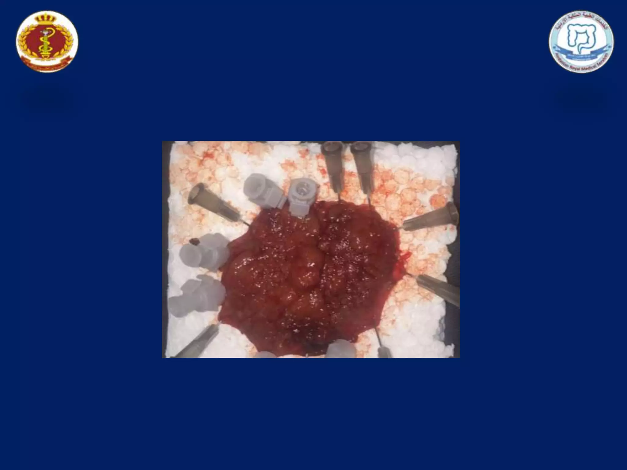 Trans-anal Endoscopic Microsurgery TEM | PPTX