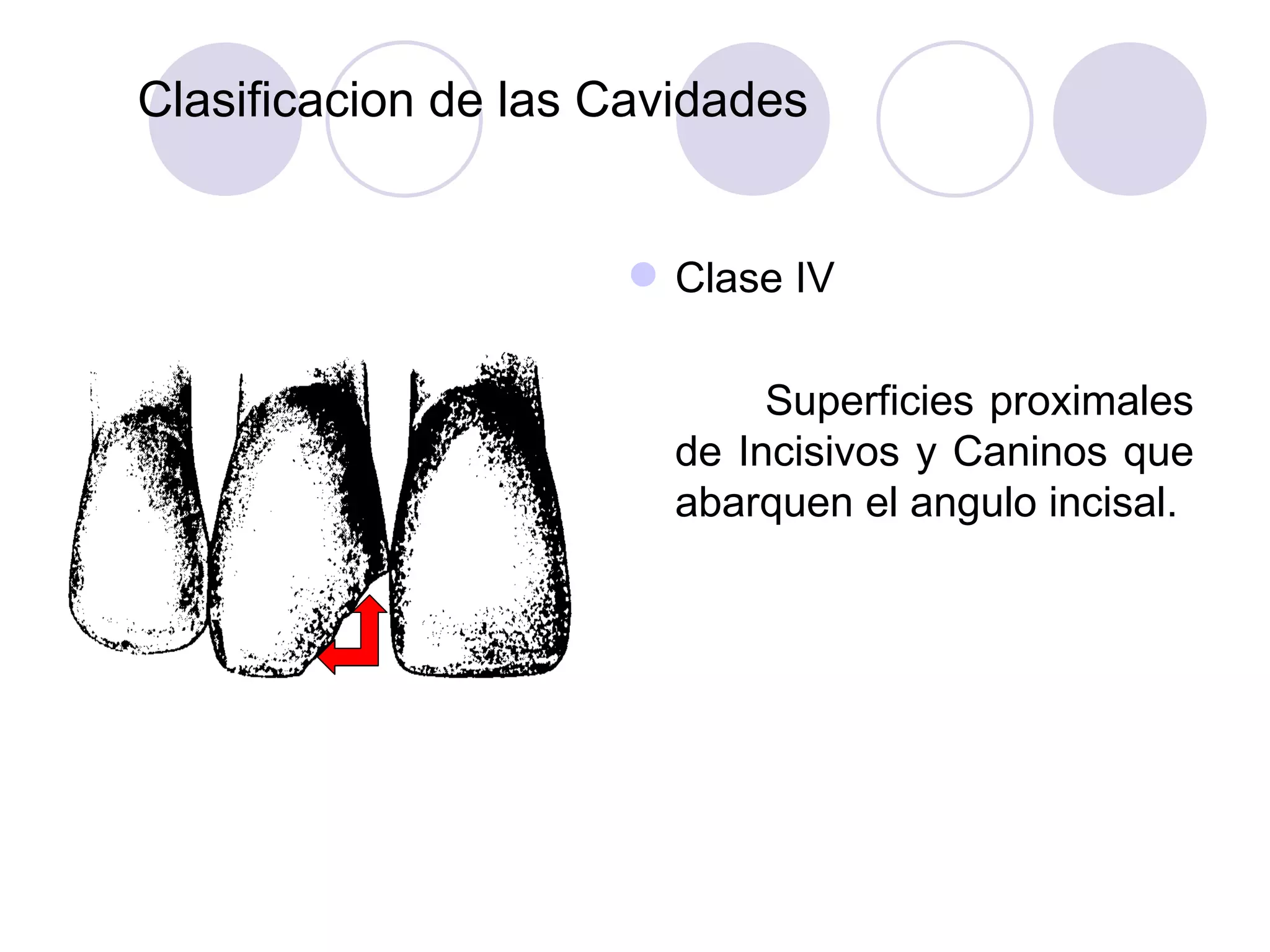 Tema 05 Nomenclatura Y Clasificacion De Las Cavidades | PPT