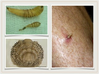 Miasis foruncular, Dermatobia Hominis | PPT | Skin and Dermatology ...