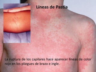 Enfermedades Exantematicas por Dr Marioh. | PPT