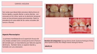 TEMA 15 CARIES DENTAL EN CARRERA DE ODONTOLOGÍA | PPTX
