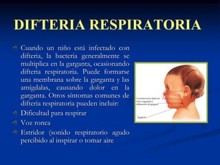 TEMA 21 DIFTERIA.pptx