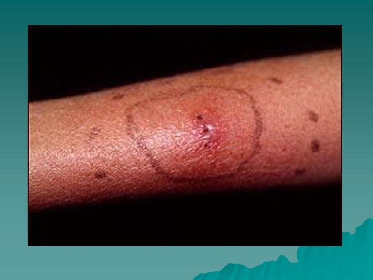 Tema 3 heridas