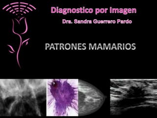 Anatomia Mamográfica Patrones Mamarios y Lexico en Mamografia | PPTX