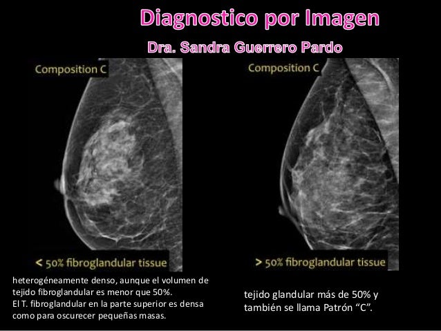 Anatomia Mamográfica Patrones Mamarios y Lexico en Mamografia