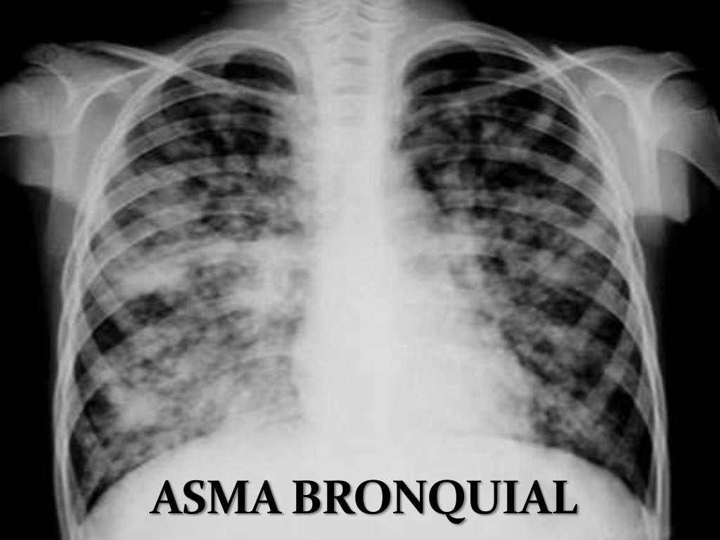 Asma bronquial