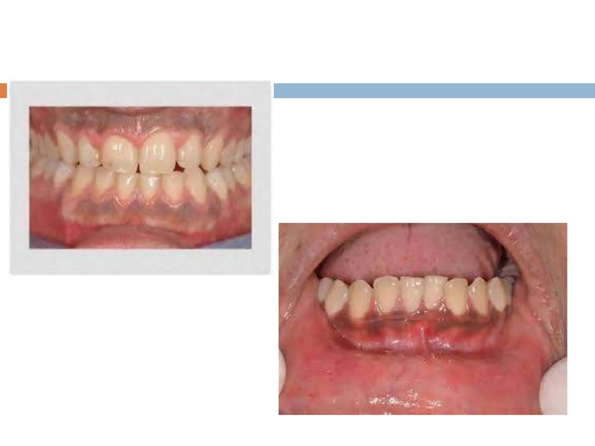 TEMA 5, PIGMENTACION DE LOS TEJIDOS BUCAL Y PERIBUCAL PATOLOGIA BUCAL.pptx
