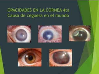 TEMA 6 CORNEA Y SUS ALTERACIONES UDABOL.pptx
