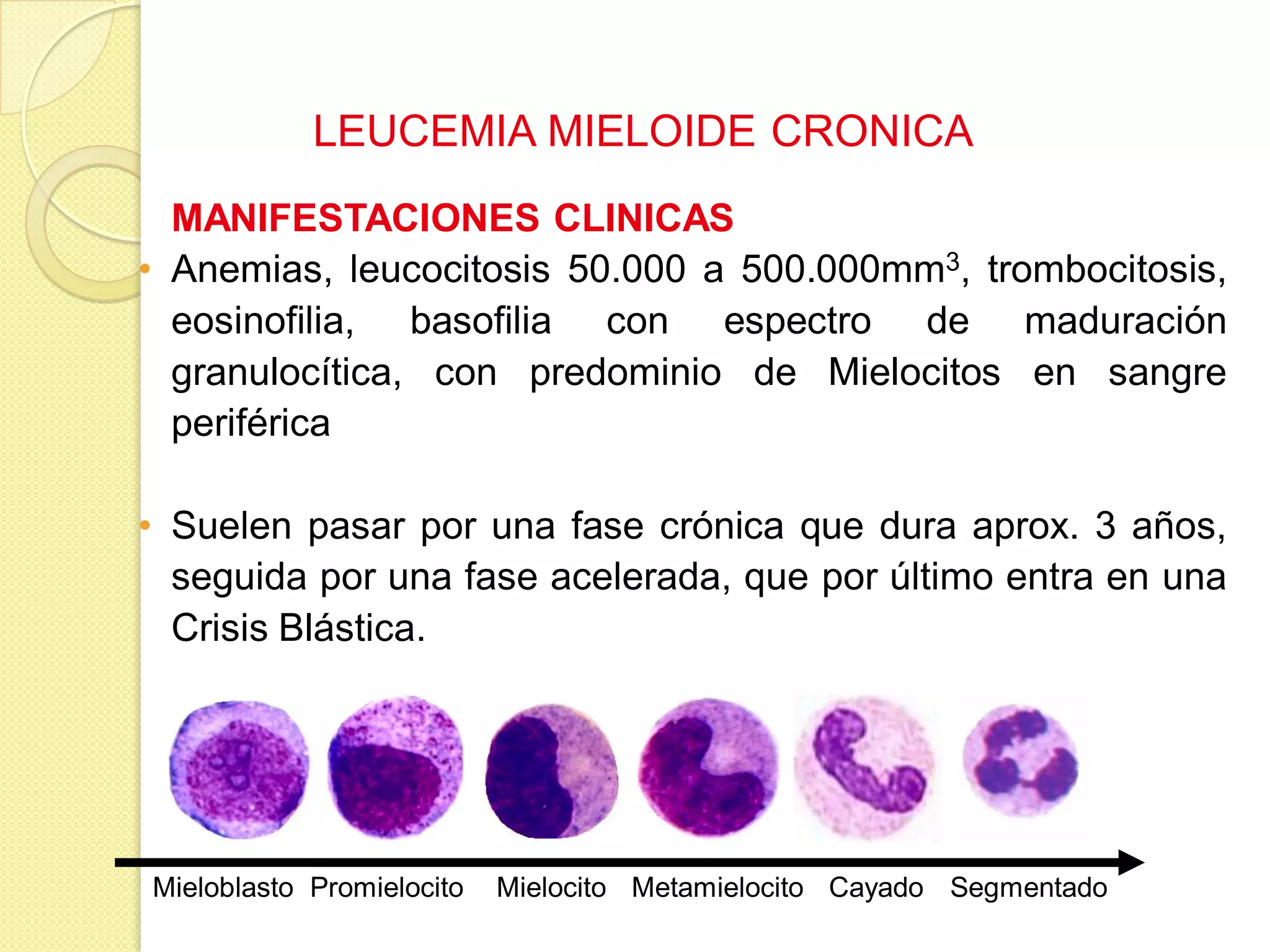 Tema 6 Neoplasias (Leucemias) | PDF