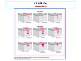 Comprehensive Overview of Wound Healing and Scar Formation Processes | PDF