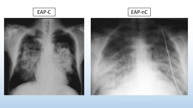 Edema Agudo do Pulmão - Manejo