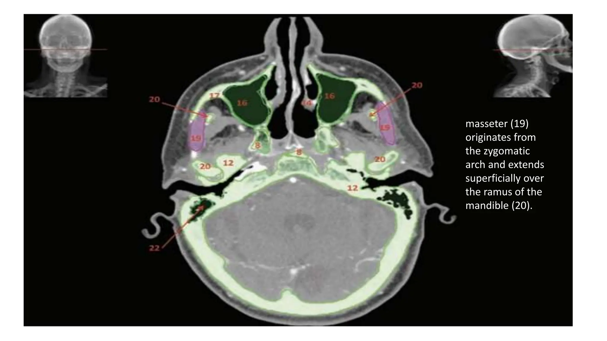Tomografia axial Cabeza Y Cuello corts y partes.pptx
