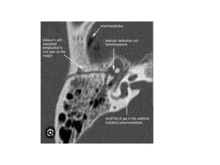 Temoral bone fractures- otic capsule involving and sparing | PPTX