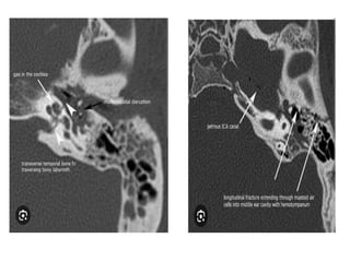Temoral bone fractures- otic capsule involving and sparing | PPTX