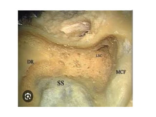 Temoral bone fractures- otic capsule involving and sparing | PPTX