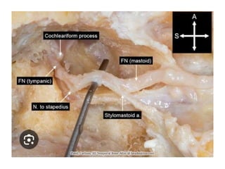 Temoral bone fractures- otic capsule involving and sparing | PPTX