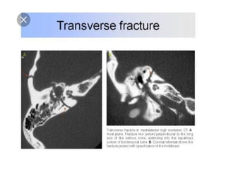 Temoral bone fractures- otic capsule involving and sparing | PPTX