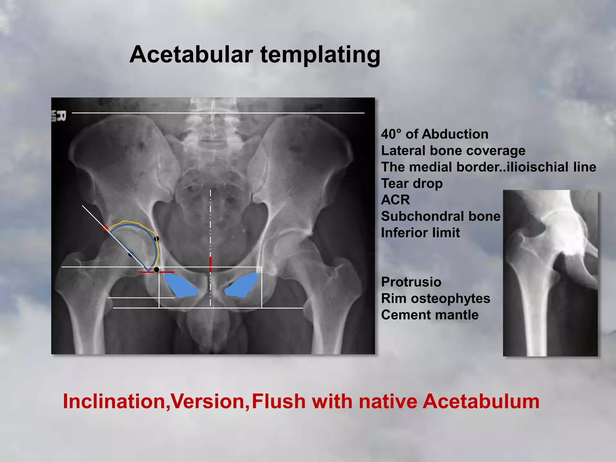 Templating of total hip replacement (THR) | PPTX