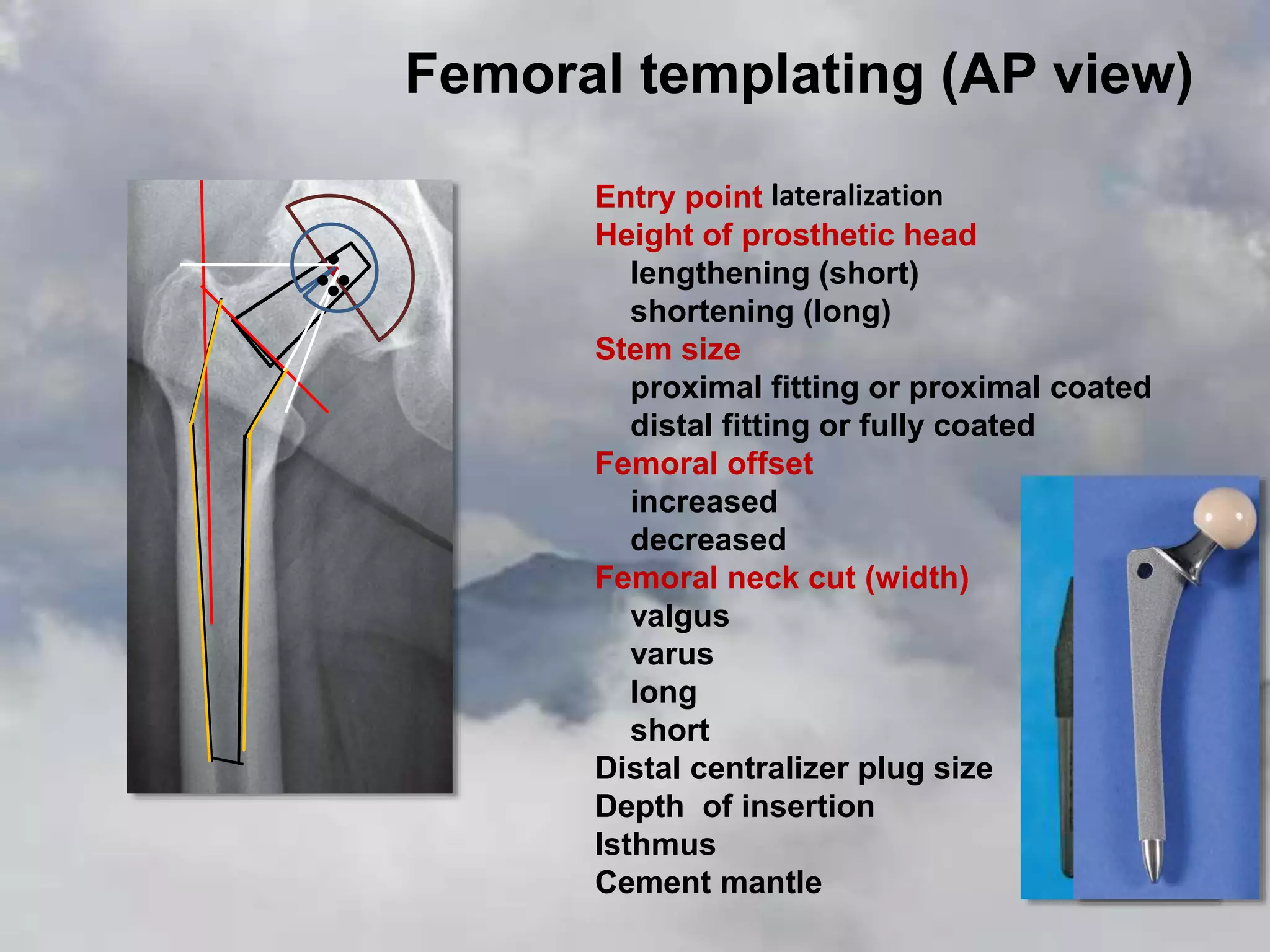 Templating of total hip replacement (THR) | PPTX