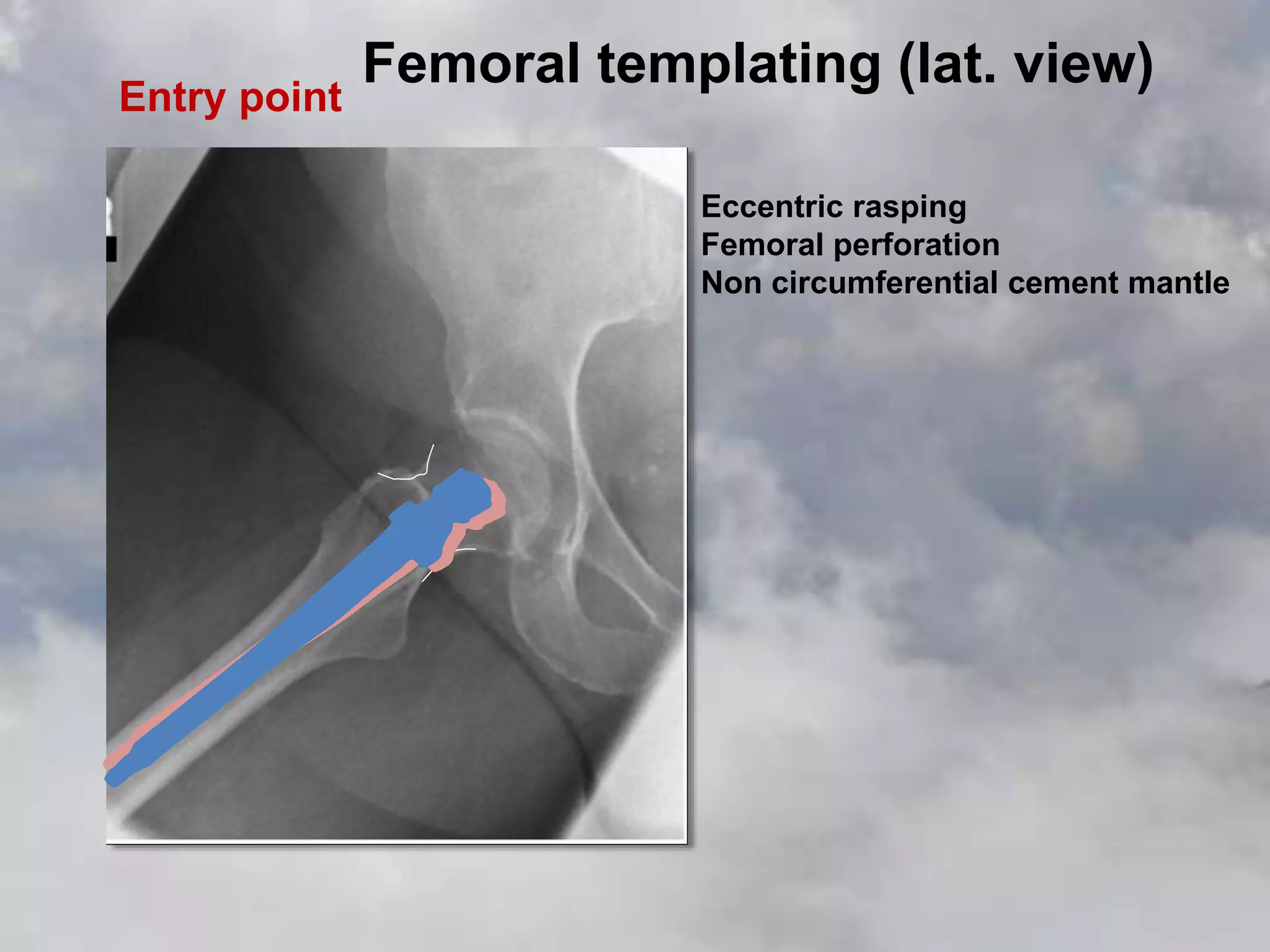 Templating of total hip replacement (THR) | PPTX