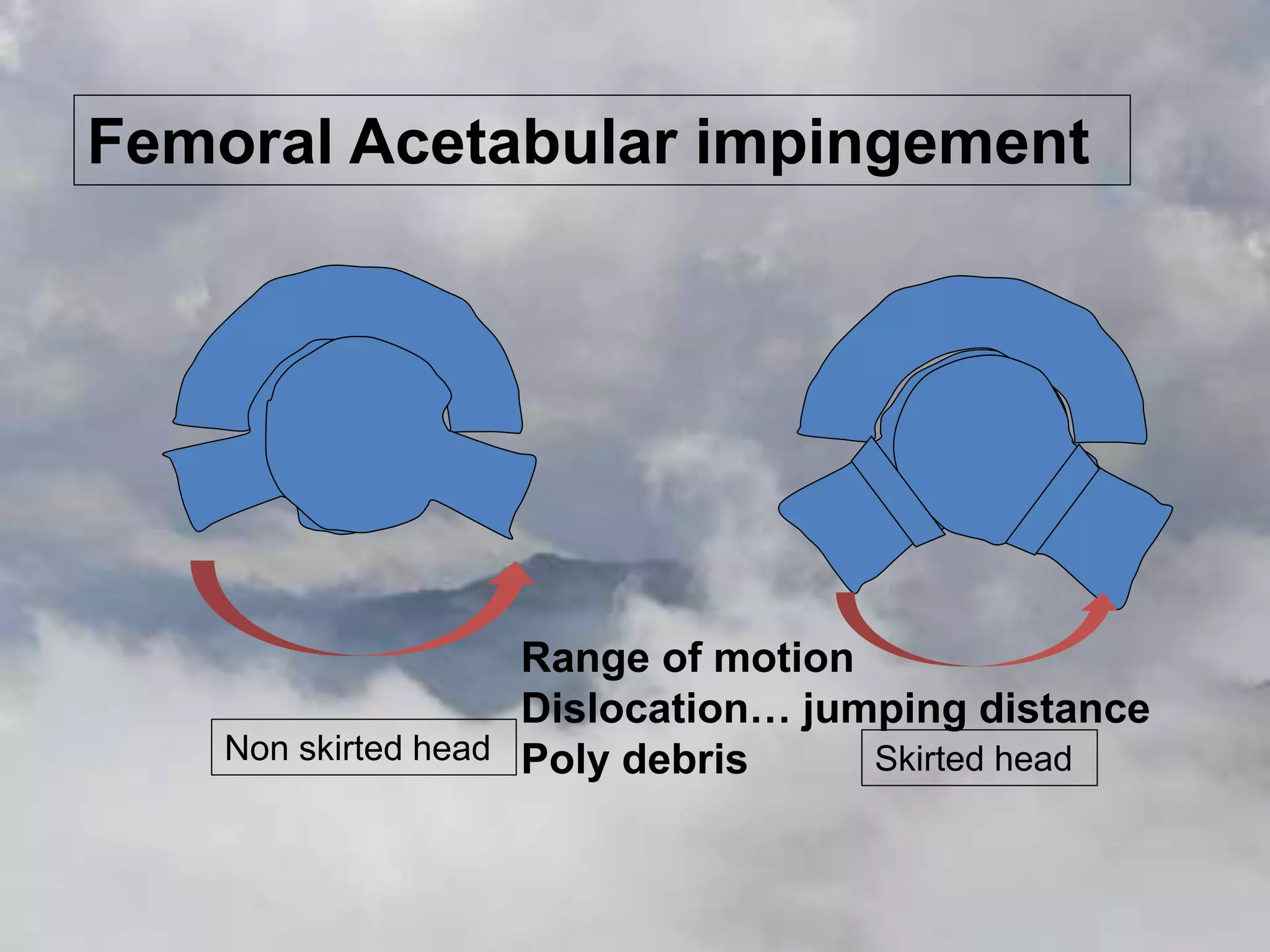 Templating of total hip replacement (THR) | PPTX