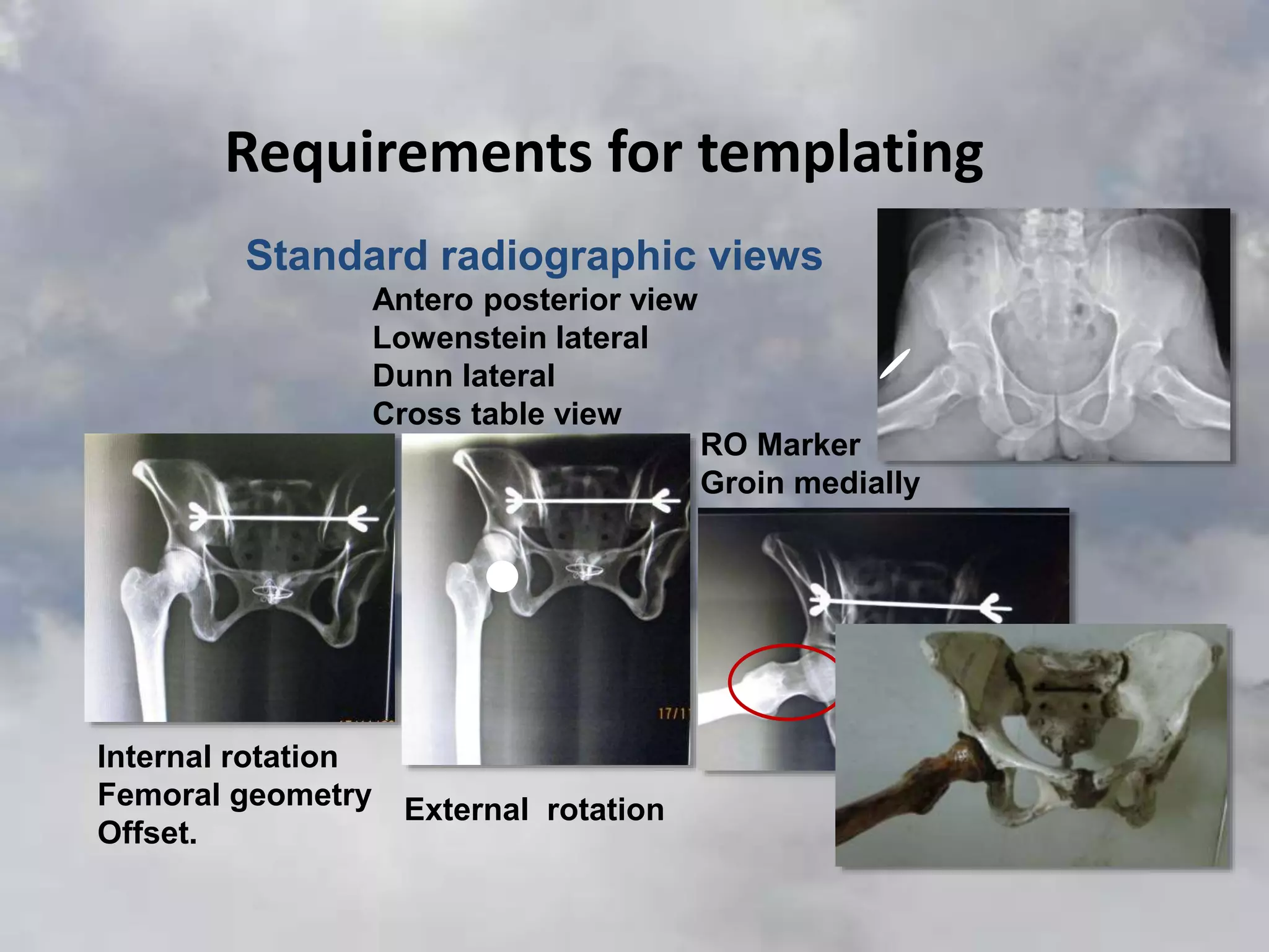 Templating of total hip replacement (THR) | PPTX