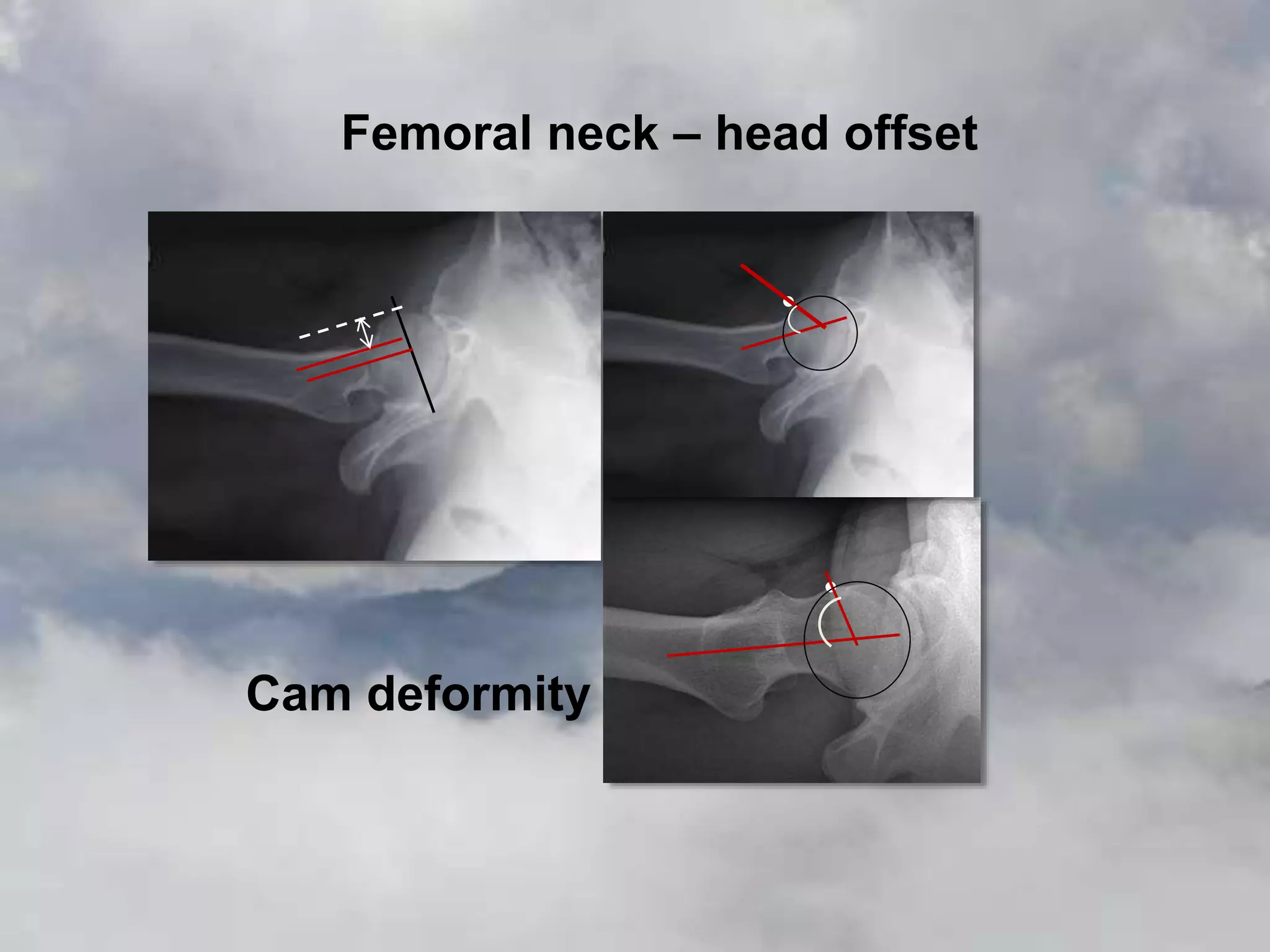 Templating of total hip replacement (THR) | PPTX