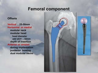 Templating of total hip replacement (THR) | PPTX