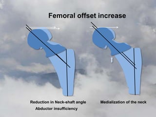 Templating of total hip replacement (THR) | PPTX