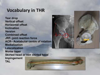Templating of total hip replacement (THR) | PPTX